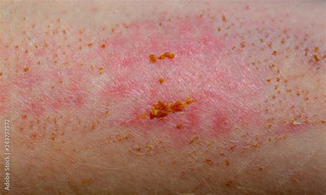 Itchy Scab