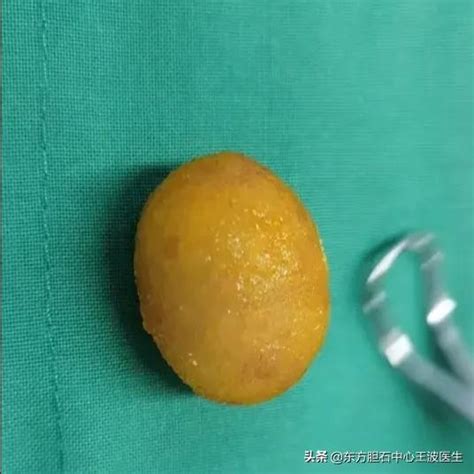 膽囊結石中最靚的那個仔兒，帶你欣賞膽固醇結晶的魅力！ 每日頭條