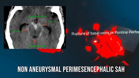 Perimesencephalic Cistern