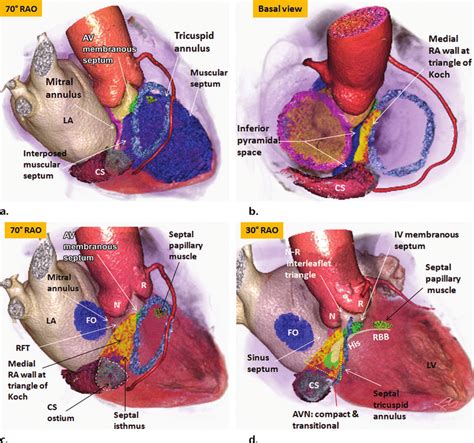 Triangle Of Koch Four Color Coded Volume Rendered Ct Images Show A