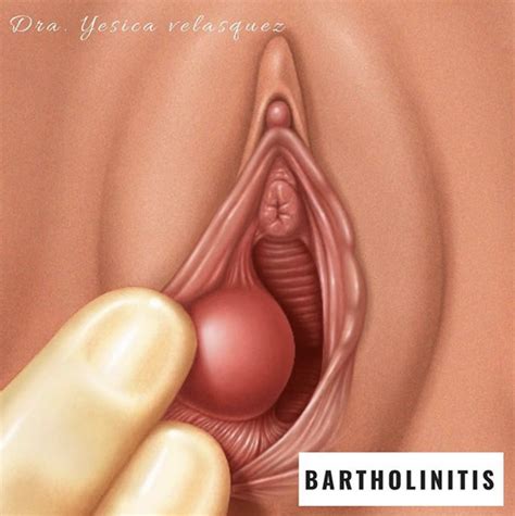 Bartholincyster Gynækologi Og Fertilitet På Vesterbro