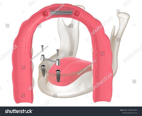 3d Render Removable Overdenture Installation On Stock Illustration