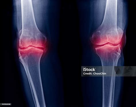 관절염 무릎 Osteophyte 마찰의 경화 공동 X 레이에 대한 스톡 사진 및 기타 이미지 Istock
