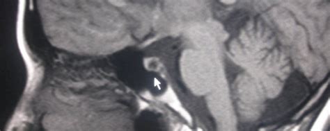 Micro Adenoma Radiopaedia