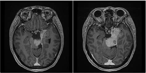 Dural Tail Observed On Gadolinium Enhanced T1 Weighted Magnetic