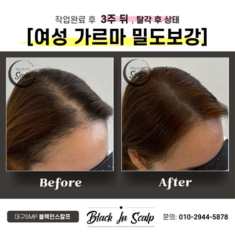 여자 정수리 탈모 대구두피문신 Smp 으로 해결