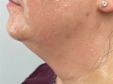 Morpheus8 REDEEM Sexual Wellness And Aesthetics Center