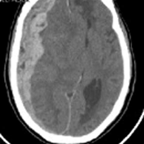 Pdf A Standardized Classification For Subdural Hematomas— I