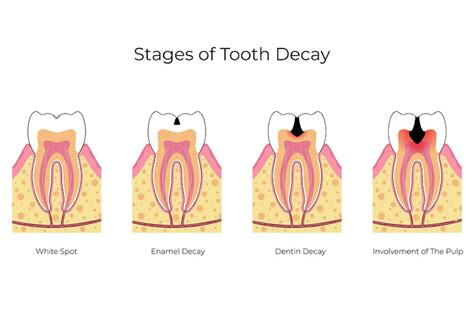 Understanding And Managing Early Enamel Caries A Comprehensive Guide