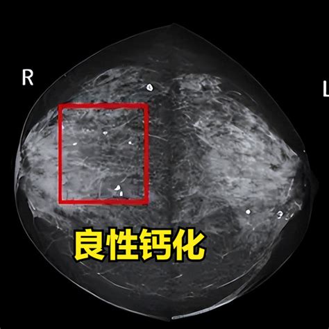 乳腺癌钼靶报告单该怎么看教你读懂乳腺钼靶报告 知乎