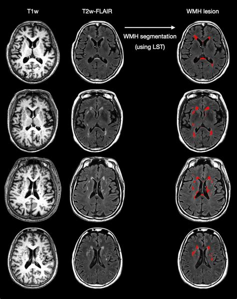 Example Of White Matter Hyperintensity Segmentation Download Scientific Diagram