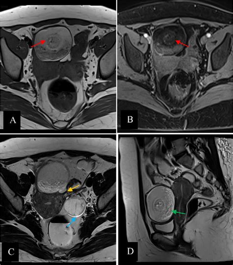 Figure 1 From Typical And Atypical Magnetic Resonance Imaging