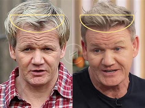 Gordon Ramsay Hair Transplant Hair Loss And Technical Analysis