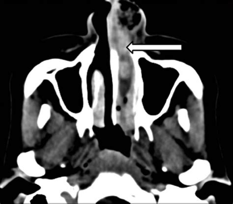 Nasal Lobular Capillary Hemangioma Journal Of Clinical Imaging Science