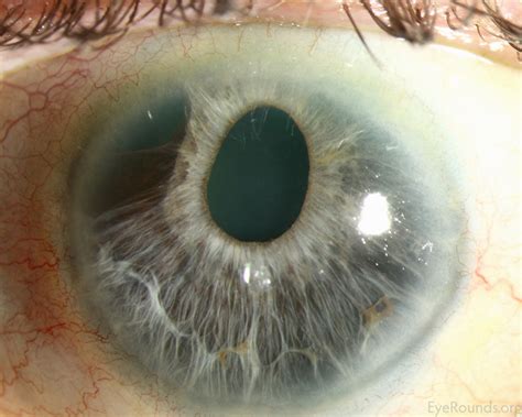 Essential Iris Atrophy Iridocorneal Endothelial Ice Syndrome