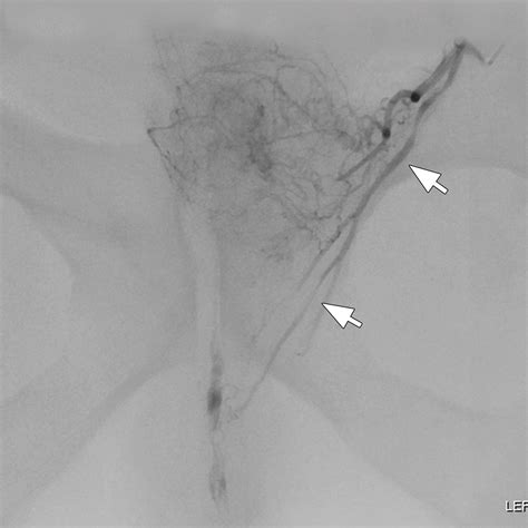 Prostatic Artery Embolization For Benign Prostatic Hyperplasia Patient