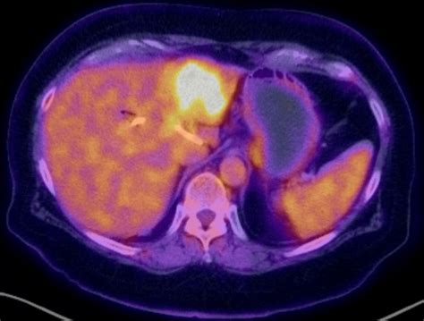 Post Operative Surveillance And Management Of Intrahepatic Cholangiocarcinoma Using Circulating