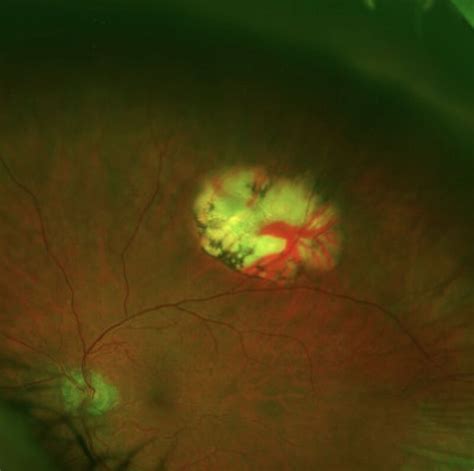 Cryotherapy Scar Following Encircling Scleral Buckle Placement For A… The Retina Society