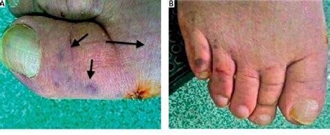 Figure 1 From Purple Stiff Lesions Resembling Varicose Veins On Lower