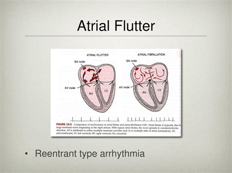 Ppt Atrial Flutter And Atrial Fibrillation Powerpoint Presentation