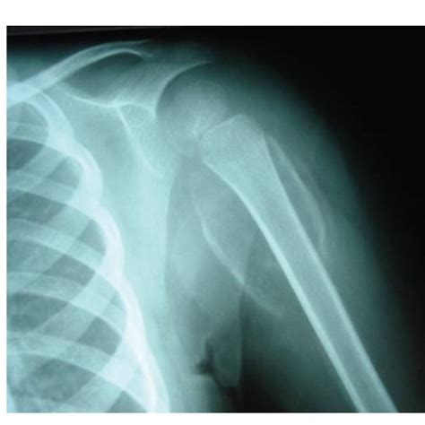 Anterior Posterior Radiograph Of The Left Shoulder Showing Osteopenia