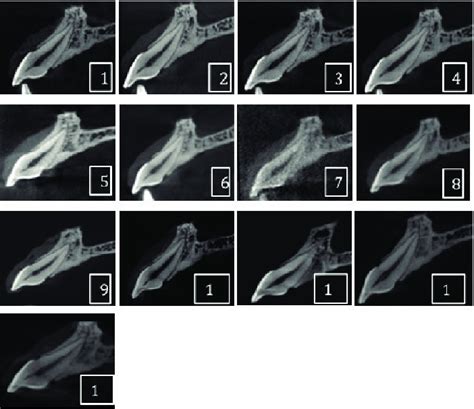 Sagittal Tomographic Reconstruction Of Tooth 11 In Different