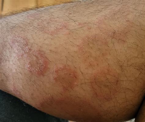 Ringworm Or Psoriasis Rdermatologyquestions