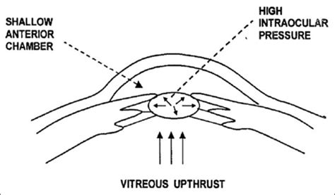 Vacuum Rhexis A Novel Capsulorhexis Technique For White Cataracts PMC