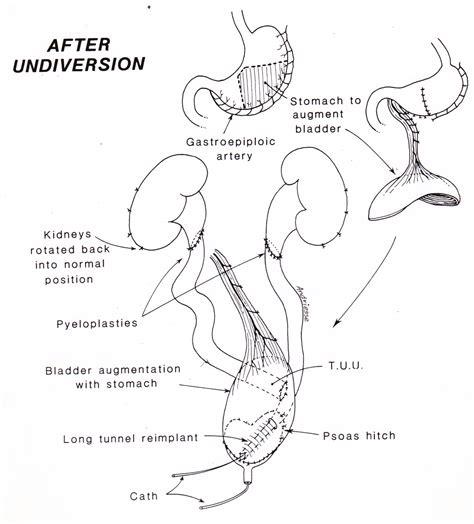 Urinary Tract Reconstruction Patient 4 Undiversion Using Gastric Augmentation W Hardy