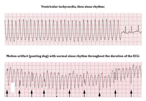 Ventricular Flutter Ecg