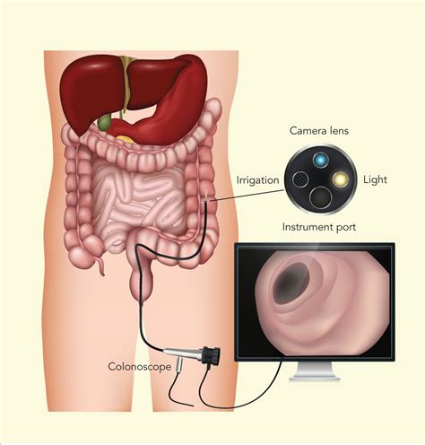 Colonoscopy Sigmoidoscopy Gastroworld Clinic Health Treatment