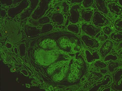 Immunofluorescence For Light Chain Reveals Diffuse Linear Staining Of
