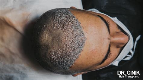 Folliculitis Causes Symptoms And Treatments Dr Cinik