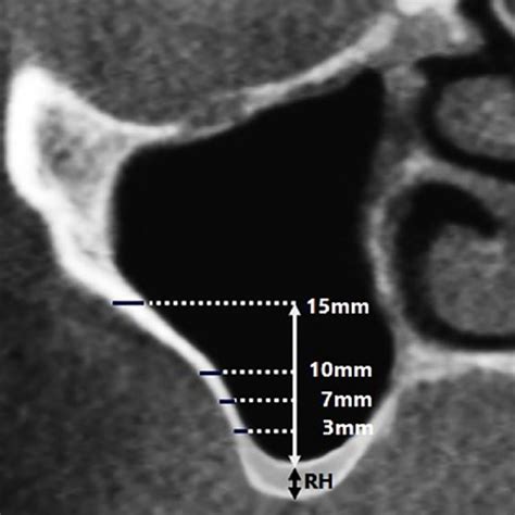 Pdf Radiographic Assessment Of Maxillary Sinus Lateral Wall Thickness