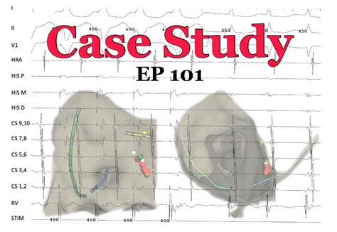 SVT Case Study 2 EP Essentials