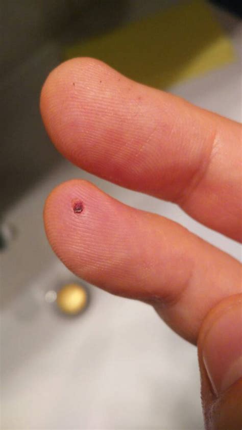 Komische Stelle Am Finger Blutet Sehr Leicht