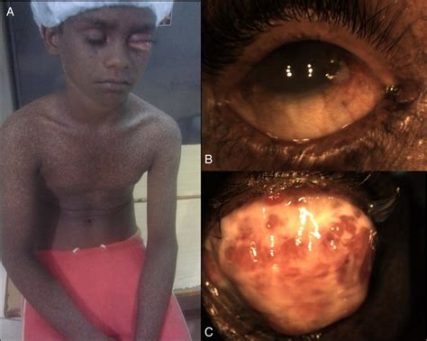 Xeroderma Pigmentosum With Bilateral Ocular Surface Squamous Neoplasia Xeroderma Pigmentosum With Bilateral Ocular Surface Squamous Neoplasia