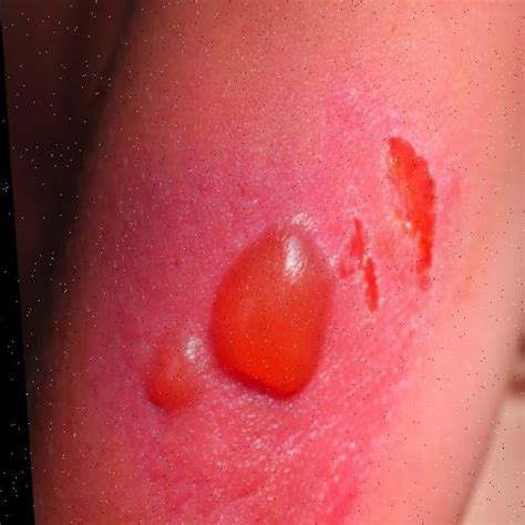 Skin Burn Object Detection Dataset By Burnwoundmodel