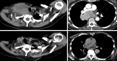 CT Scans Before And After Therapy See Text Download Scientific Diagram