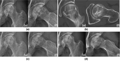 Collapsed Femoral Head