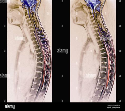 Coloured Magnetic Resonance Imaging Mri Scans Of The Healthy Spine Of