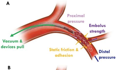 Sofia Catheter For Direct Aspiration Of Large Vessel Occlusion Stroke