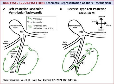 Reverse Type Left Posterior Fascicular Ventricular Tachycardia A New