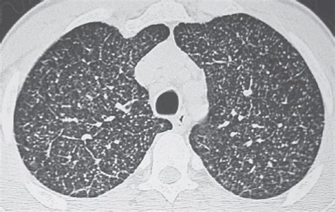 Pediatric Ild Radiology At Johnnie Sharp Blog
