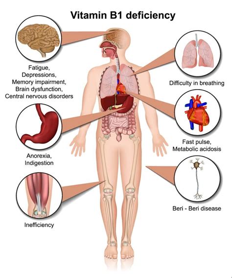 Vitamin B Deficiency Beriberi Thiamin Vitamin B1 Coenzyme