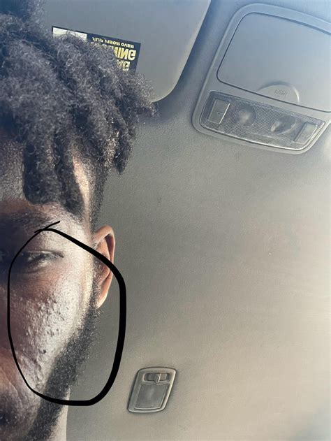 How Do I Get Rid Of Bumpy Skin Texture Is It Genetic R Skincare Addiction