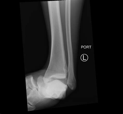 Medial Subtalar Dislocation A Case Report JETem