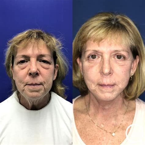 Facial Plastic Surgery Dr Mark Markarian Plastic Surgery Of Boston