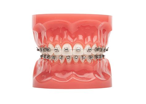 Metal Braces Ss Orthodontics