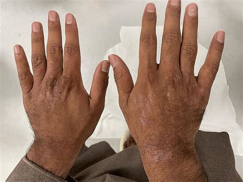 Multiple Scaly Hyperkeratotic Nodules And Excoriations Over The Dorsal